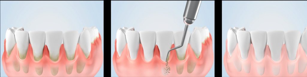 PARODONTOSE - Naqshbandi Sufi New York